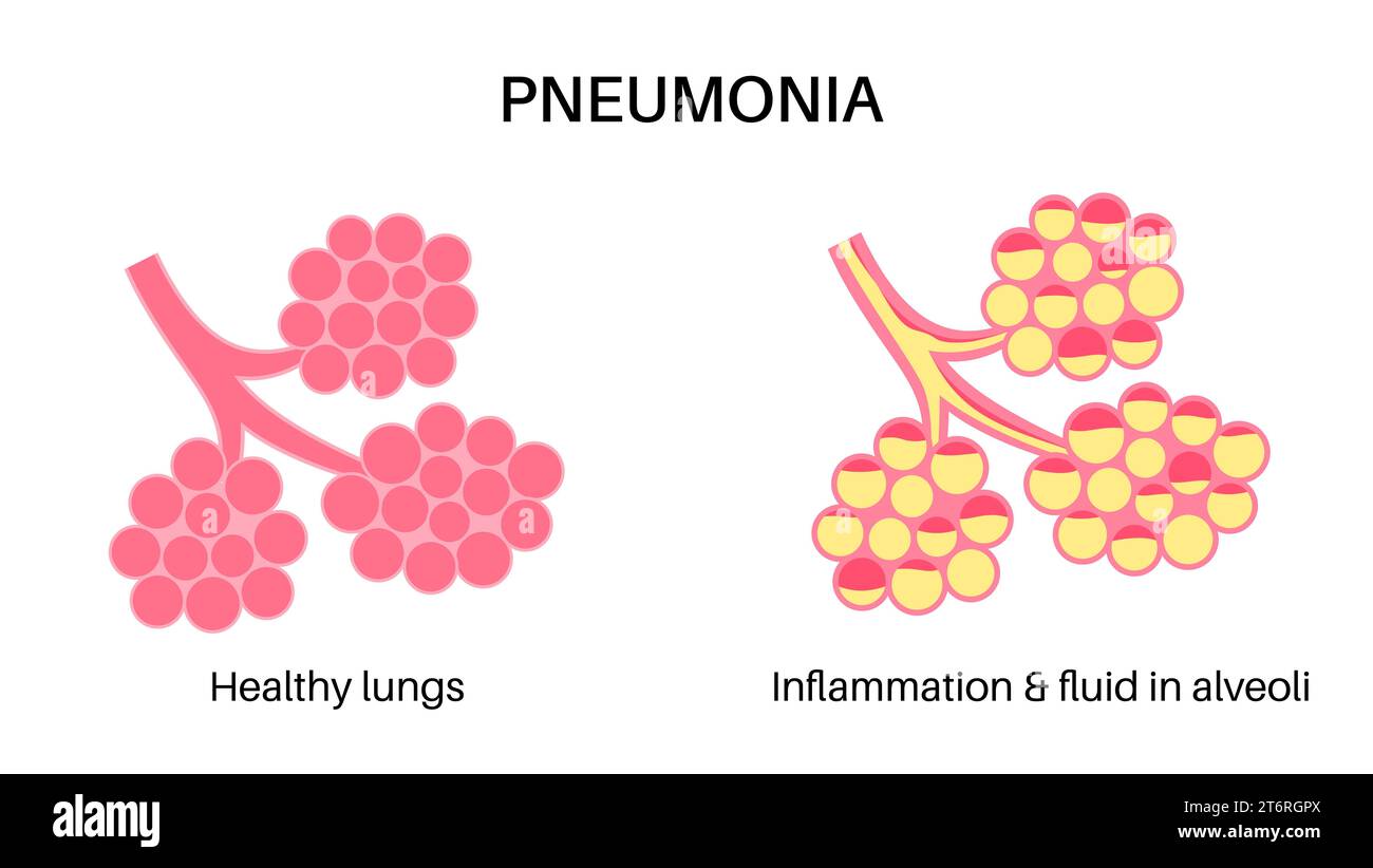 Pneumonia lung hi-res stock photography and images - Alamy