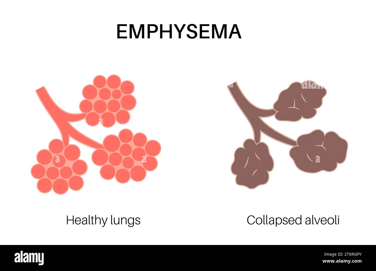 Emphysema lung tissue hi-res stock photography and images - Alamy