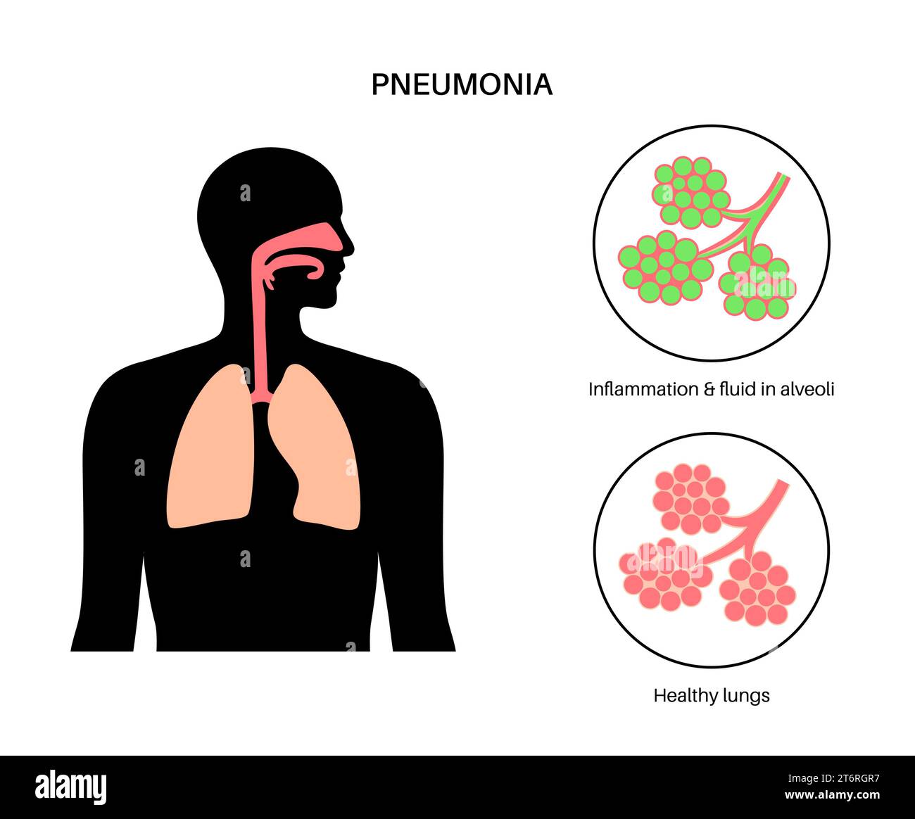 Pneumonia alveolus Cut Out Stock Images & Pictures - Alamy