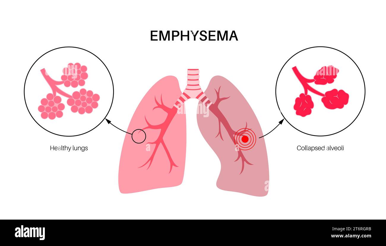 Tissue emphysema hi-res stock photography and images - Alamy
