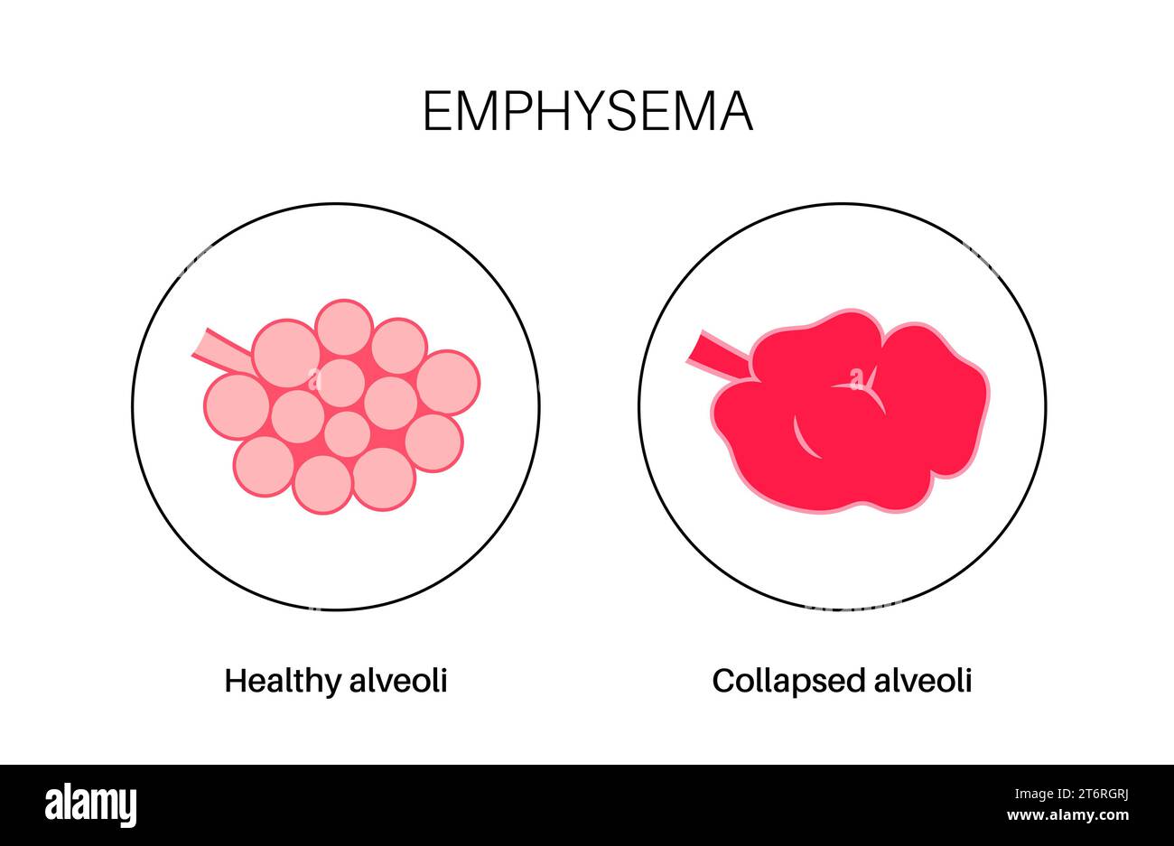 Tissue emphysema hi-res stock photography and images - Alamy