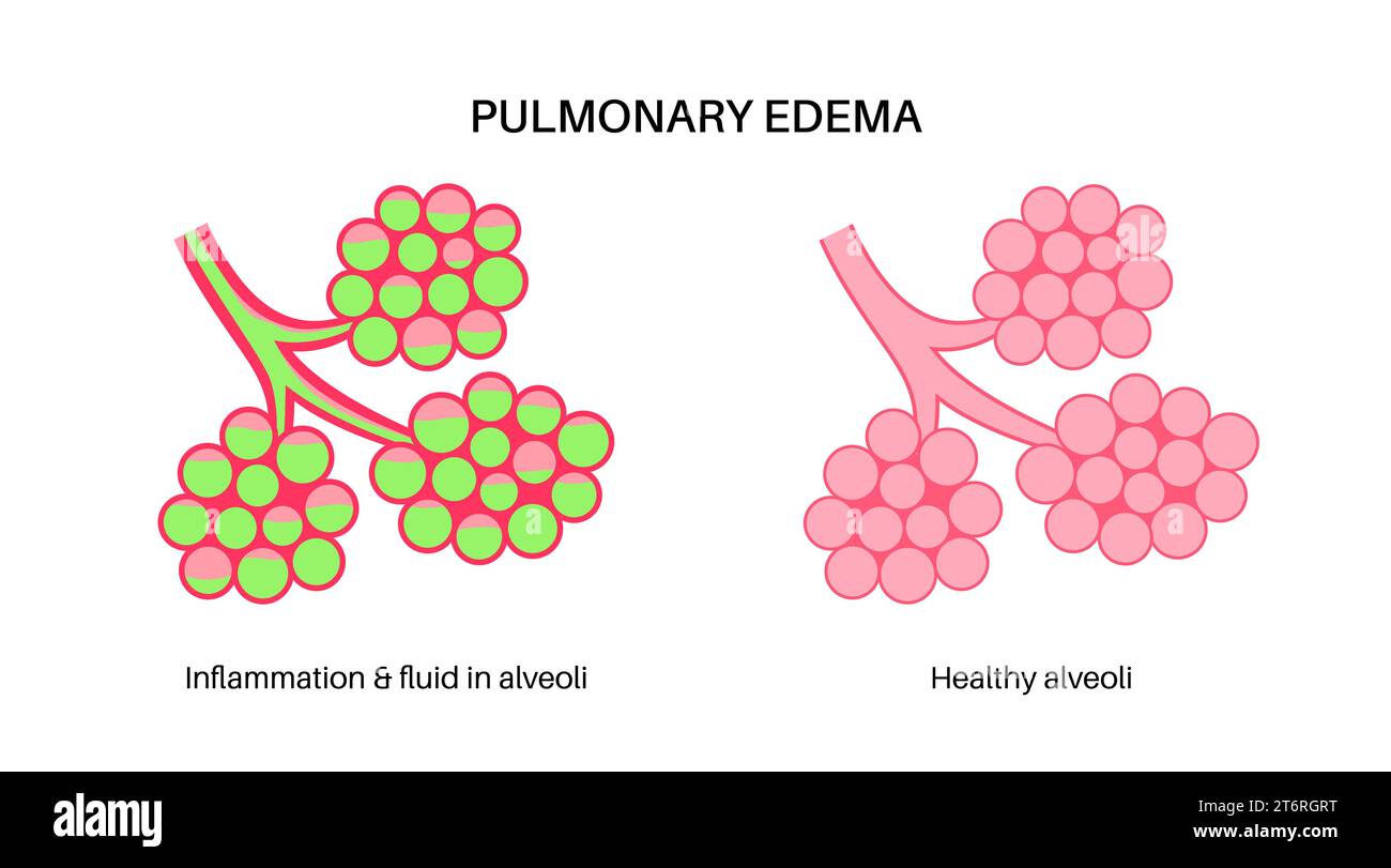 Pulmonary oedema, illustration Stock Photo - Alamy