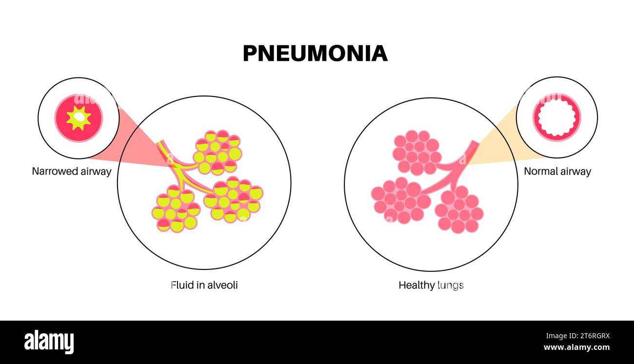 Illness pneumonia Cut Out Stock Images & Pictures - Alamy