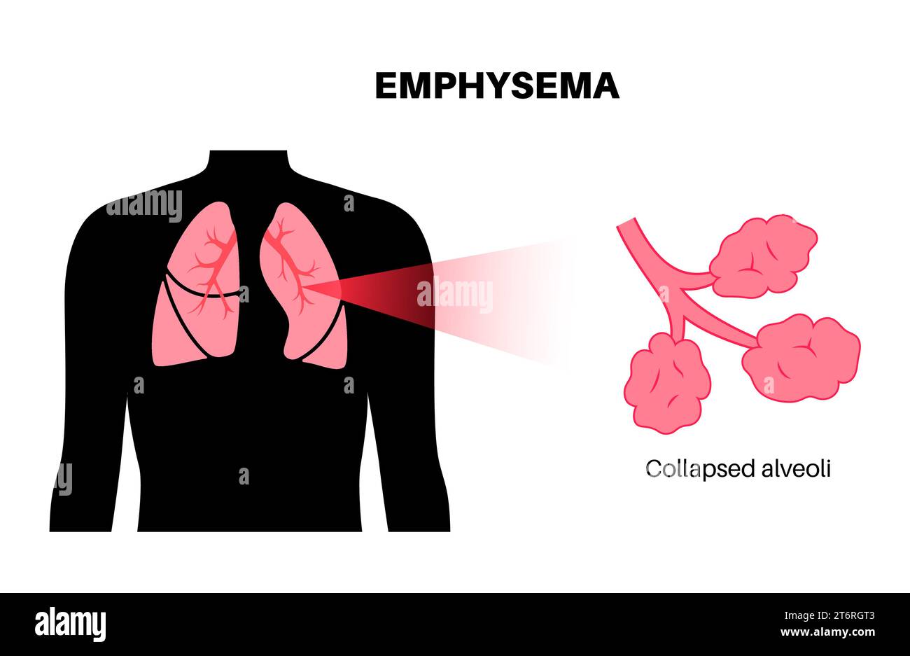 Tissue emphysema hi-res stock photography and images - Alamy