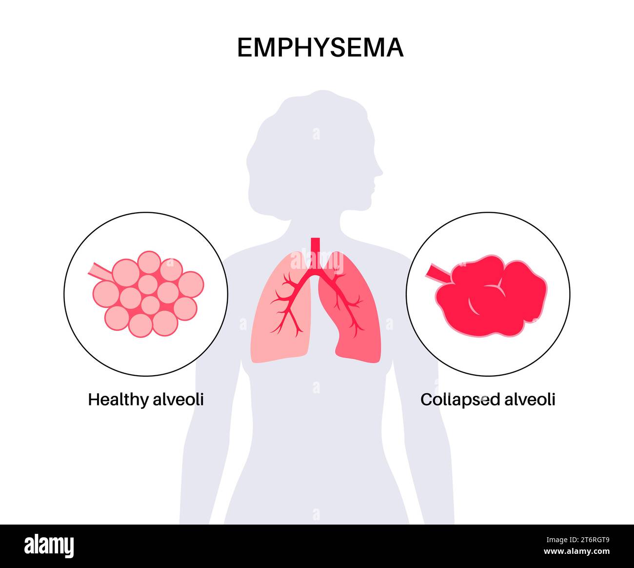 Emphysema lung hi-res stock photography and images - Alamy