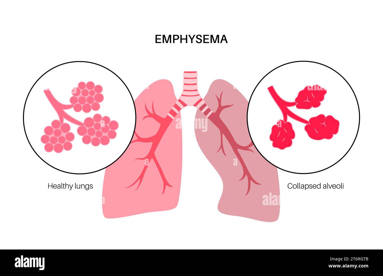 Emphysema lung hi-res stock photography and images - Alamy