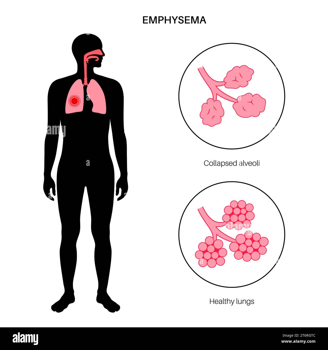 Emphysema alveoli diagram hi-res stock photography and images - Alamy