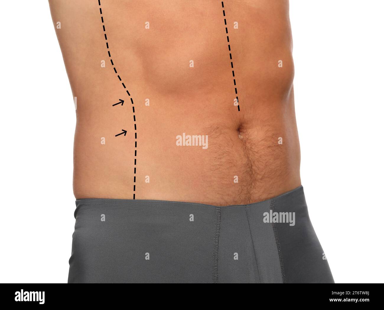 Man with markings for cosmetic surgery on his abdomen against white ...