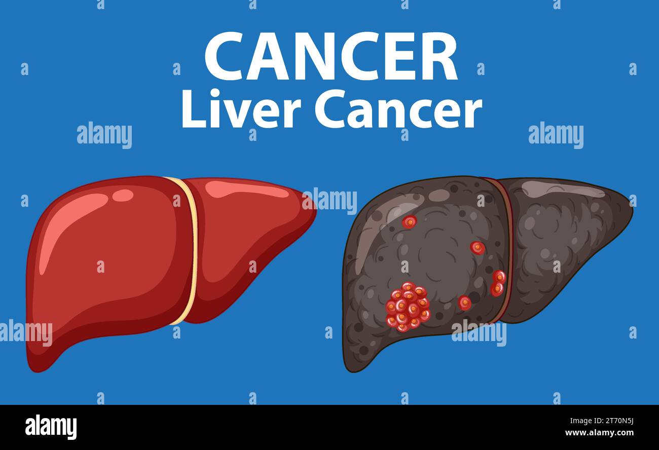 Infographic illustrating the differences between healthy and cancerous liver cells Stock Vector ...