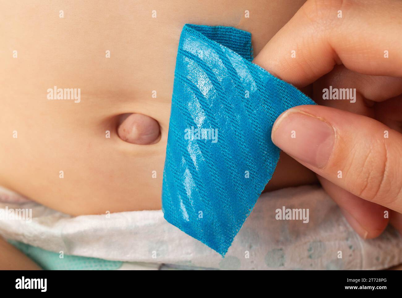 Mother's hands seal the umbilical hernia of a newborn child with a blue ...