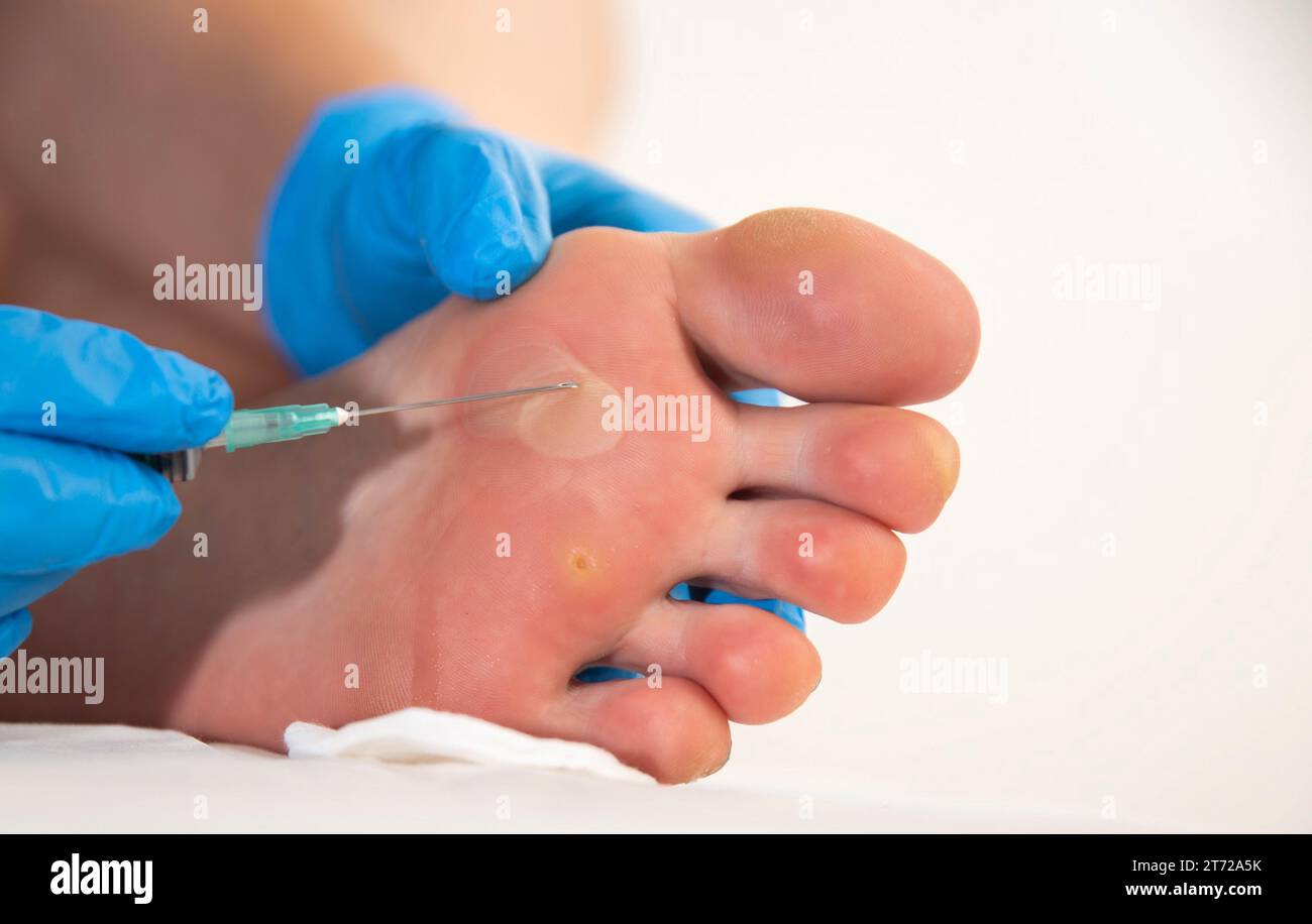 surgery to pierce and remove fluid from a callus on the foot, close-up ...