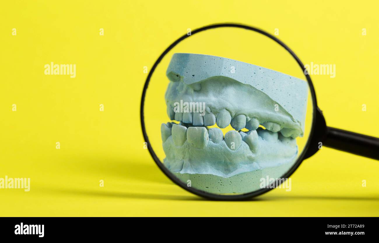 Medical plaster cast of a dental jaw with teeth on a yellow background ...
