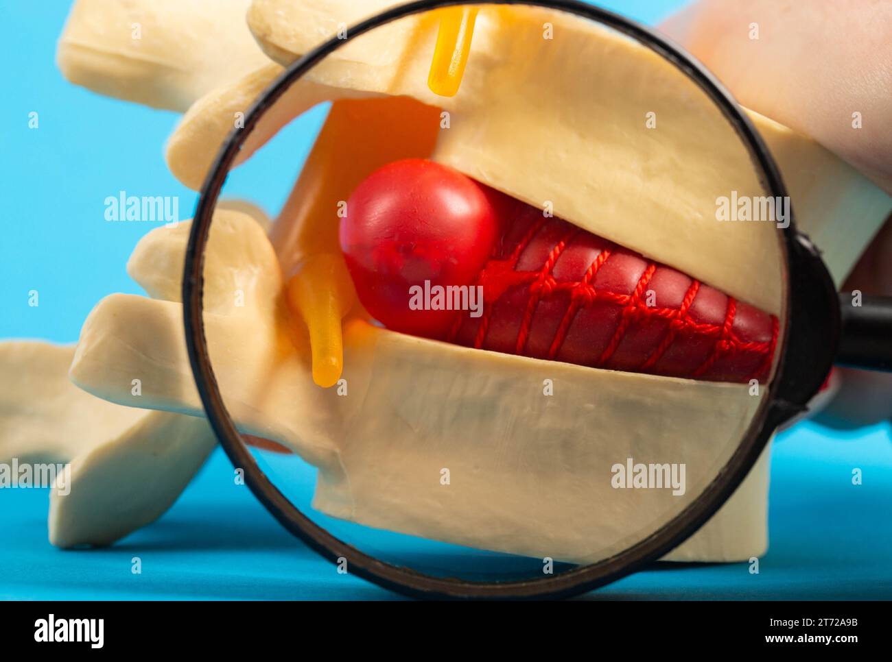 Inflamed red herniated disc of the spine under a magnifying glass ...
