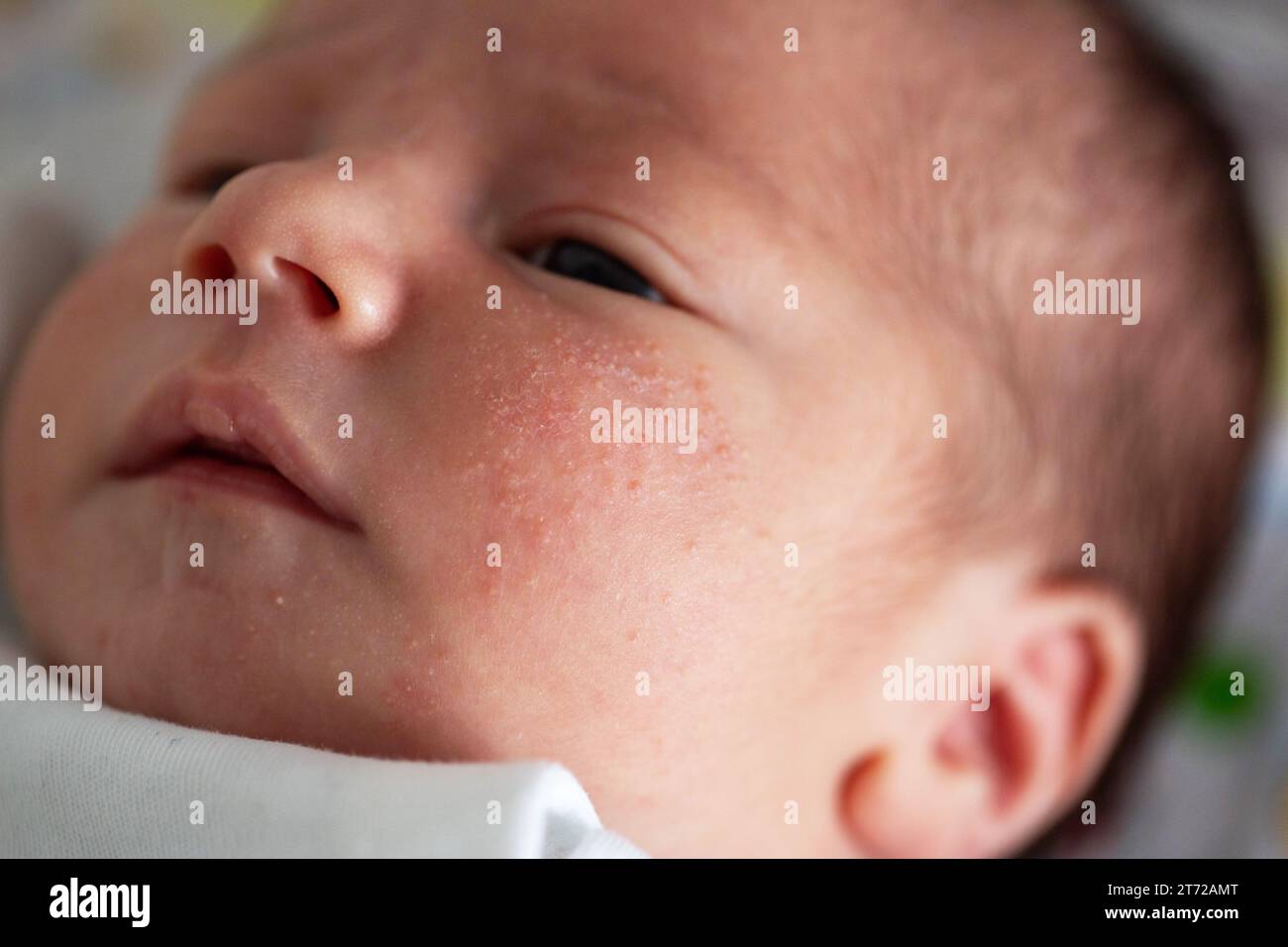 Pimples on the face of a newborn. Baby's adaptation to the environment ...