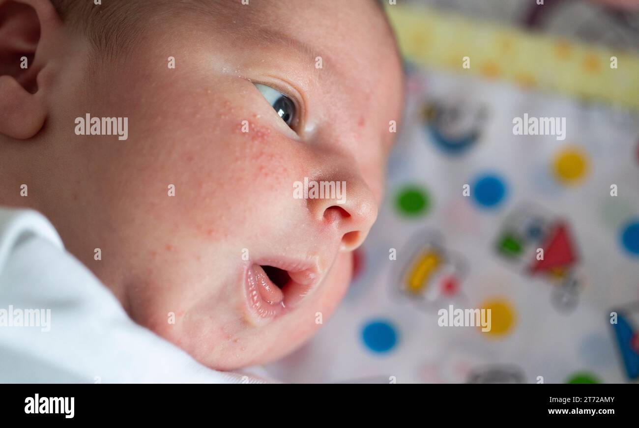 Rash on the face of a newborn baby. The process of formation of the ...