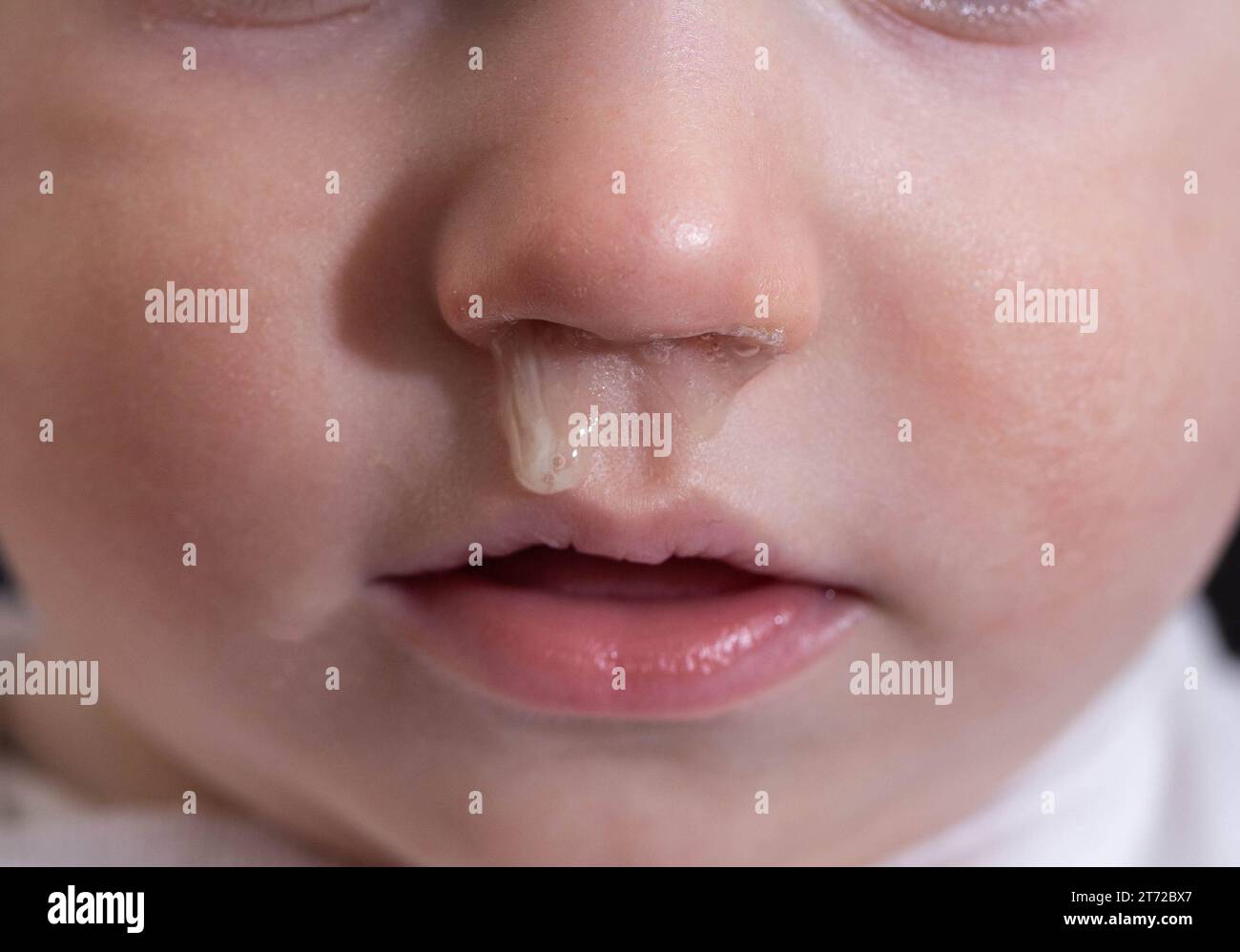 Close-up of a small child's face and nose with snot. The concept of ...