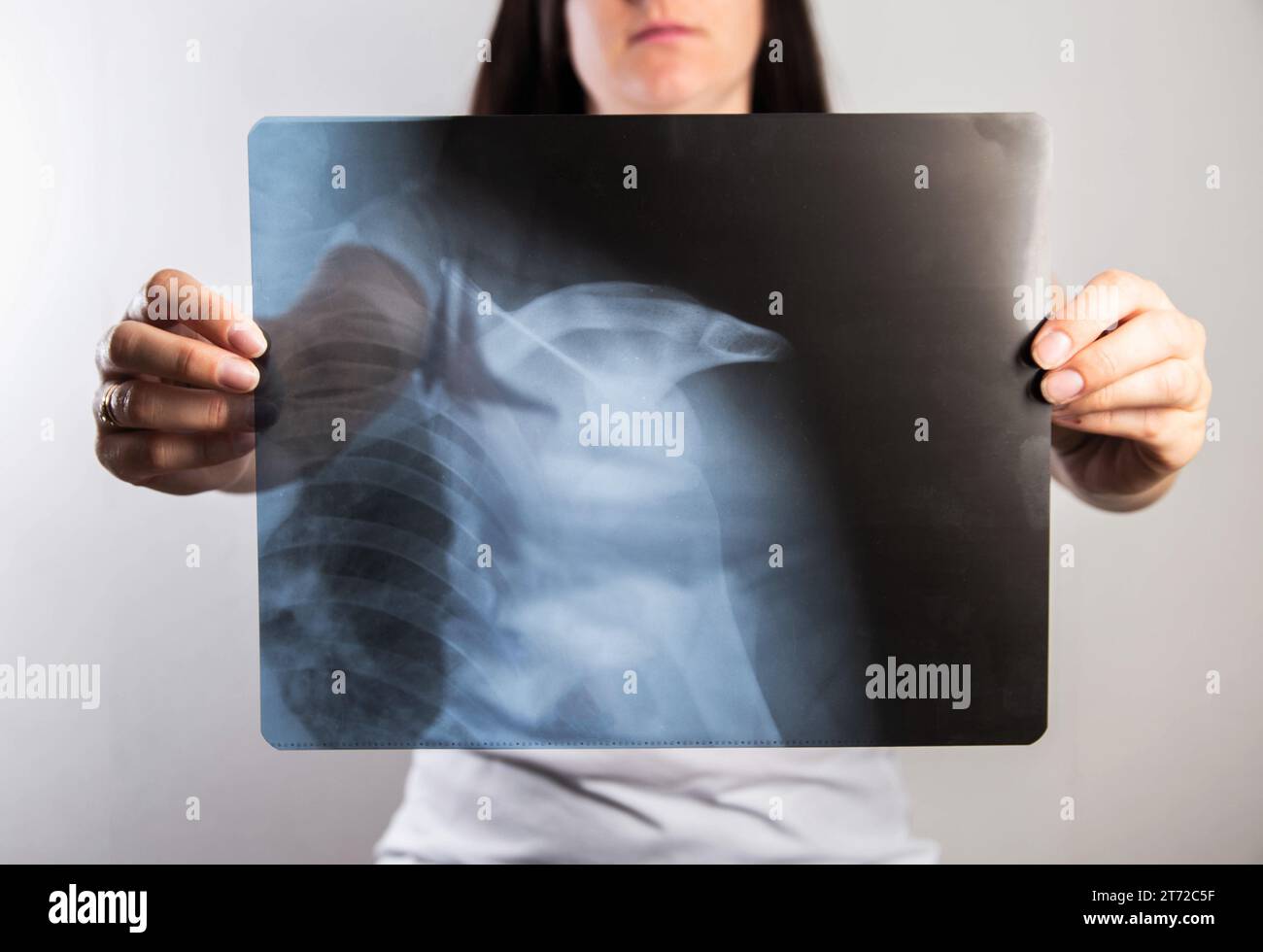 The girl holds an x-ray with outstretched arms showing a dislocation of ...