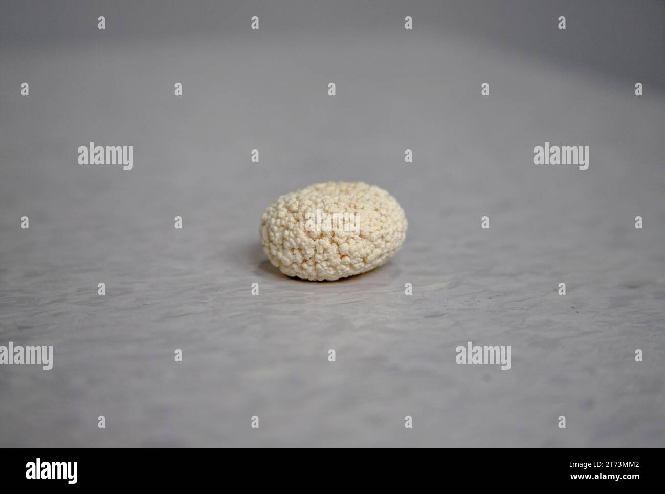 Bladder stone surgery Stock Photo - Alamy