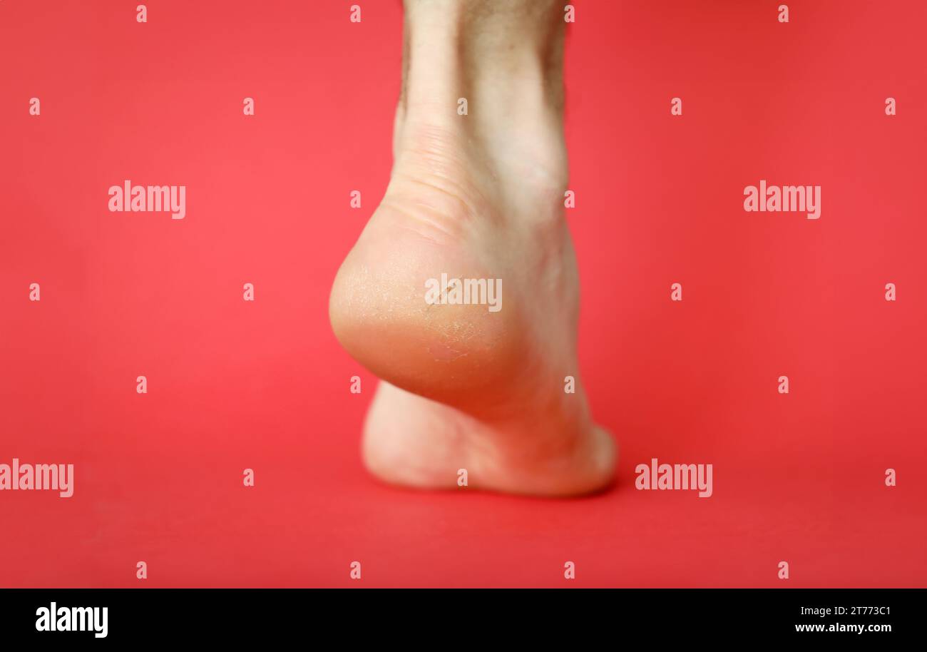 Heel with a cracked skin disease on a red Stock Photo - Alamy