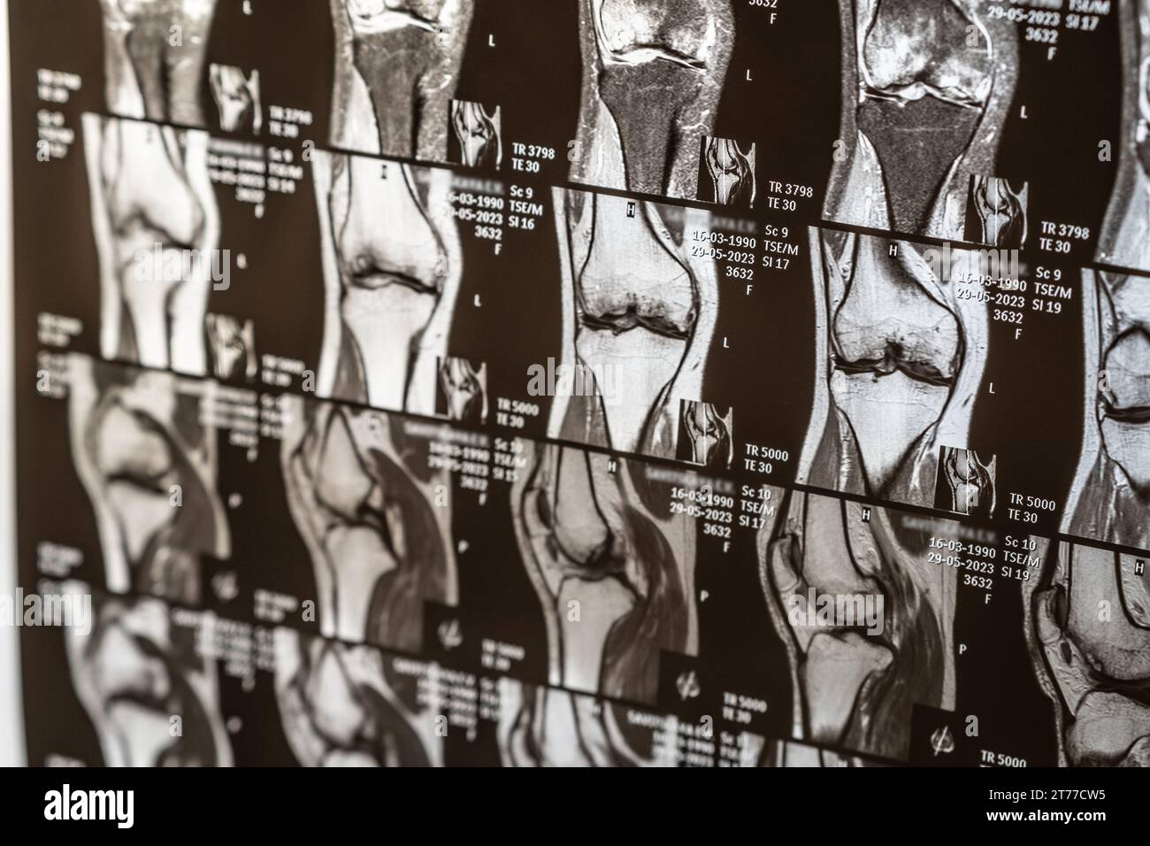 Magnetic resonance imaging of human knee joint for medical diagnosis ...