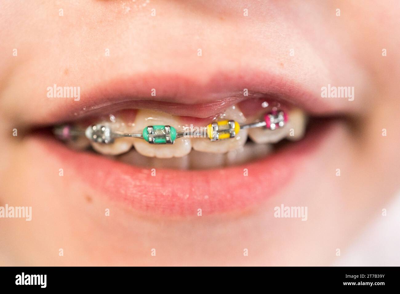 Little girl with rainbow braces Stock Photo - Alamy