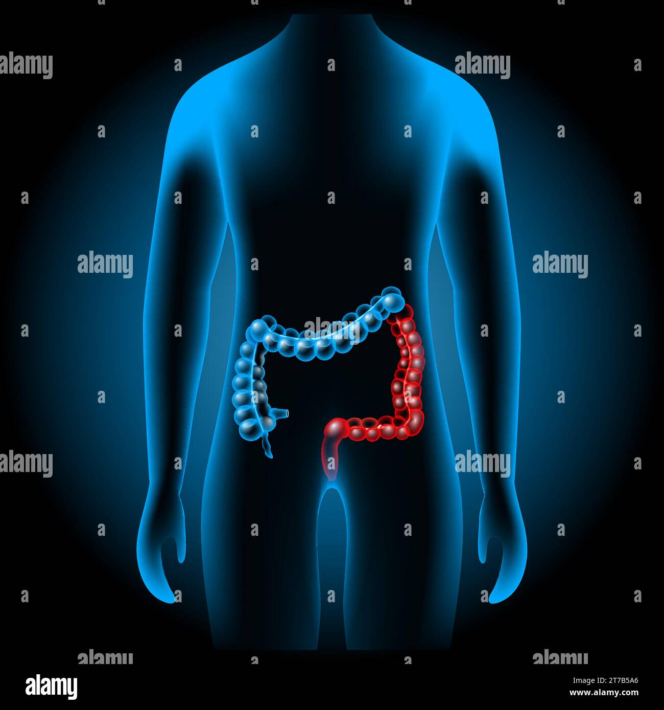 Inflammatory bowel disease. Large intestine with glowing effect on a x ...