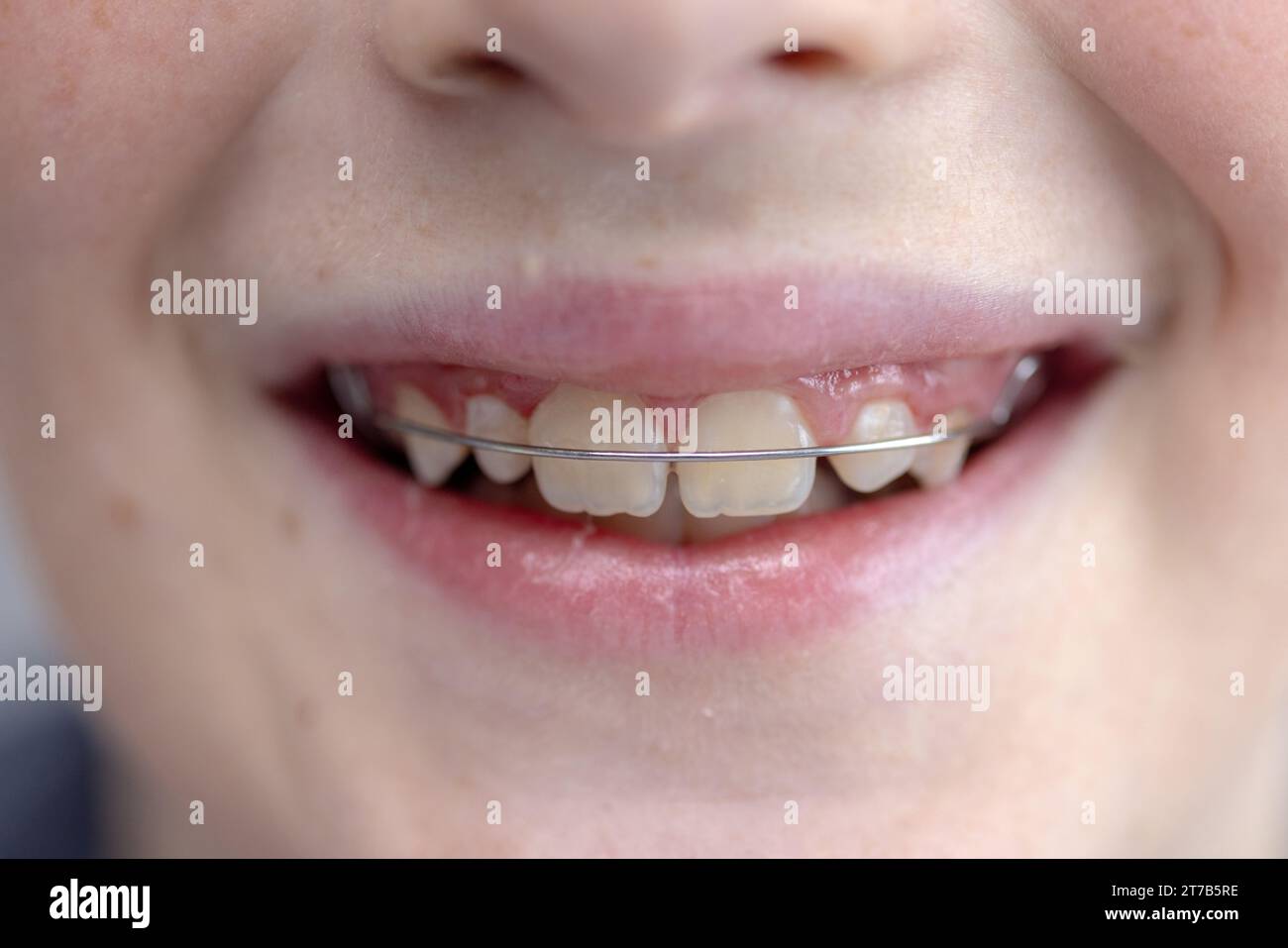 Wide smile of teenage boy, teeth with braces close-up. Young student ...