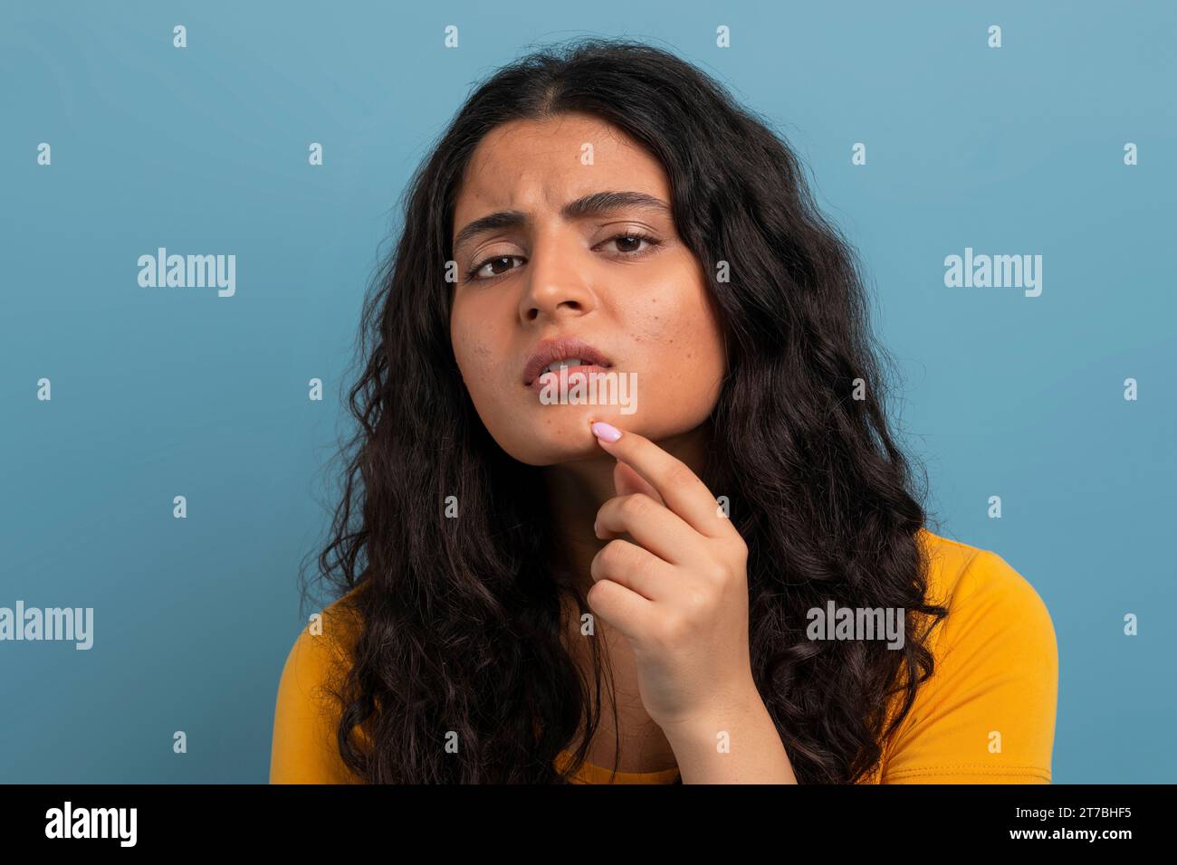Upset stressed sad acne hi-res stock photography and images - Alamy