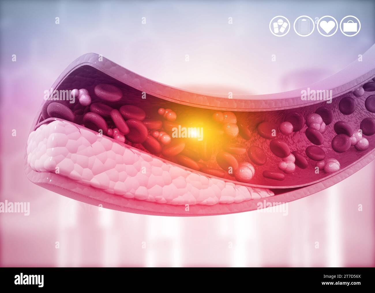 Atherosclerosis, Cholesterol plaque in artery. 3d illustration Stock ...