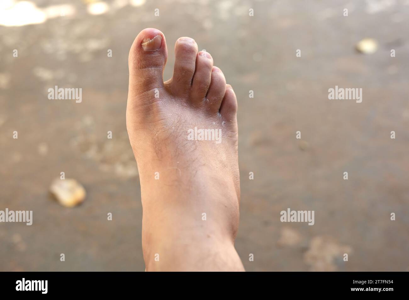 ringworm Fungal infection of the nails on the big toe. Fungal infection ...