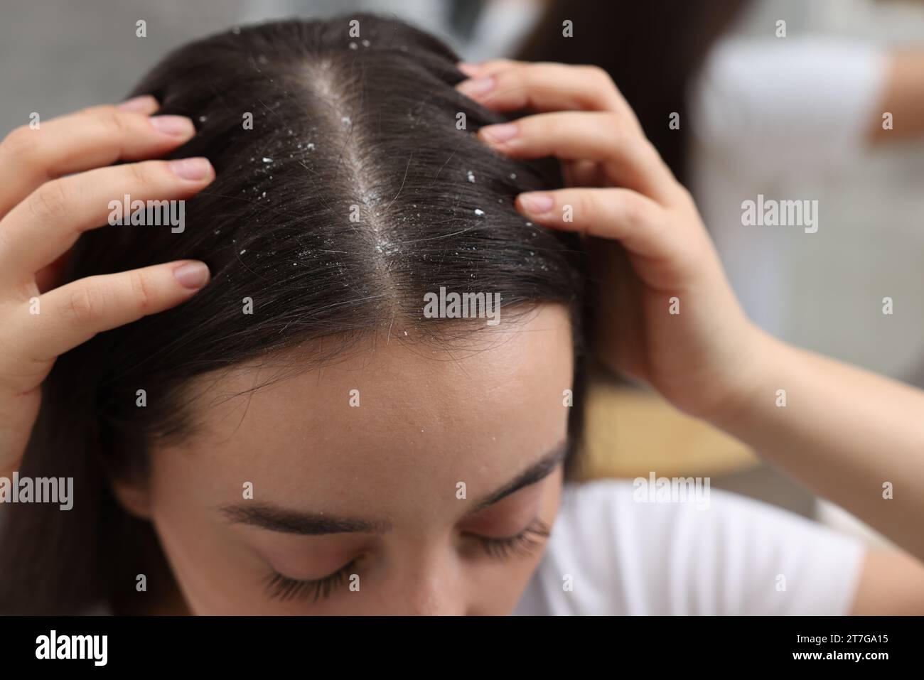 Woman examining her hair and scalp indoors, closeup. Dandruff problem ...