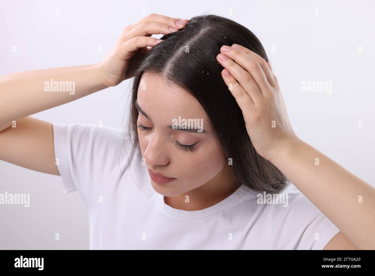 Woman with dandruff problem on white background Stock Photo - Alamy