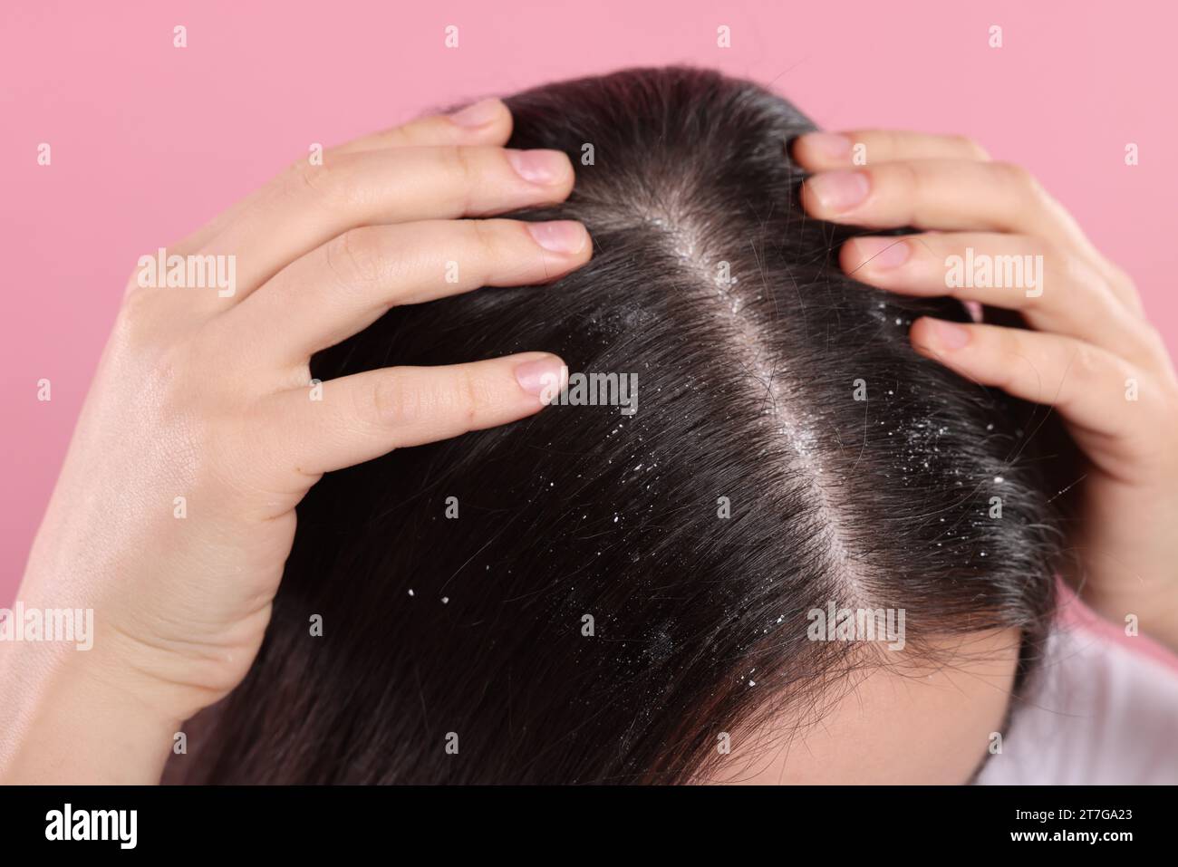 Woman with dandruff problem on pink background, closeup Stock Photo - Alamy