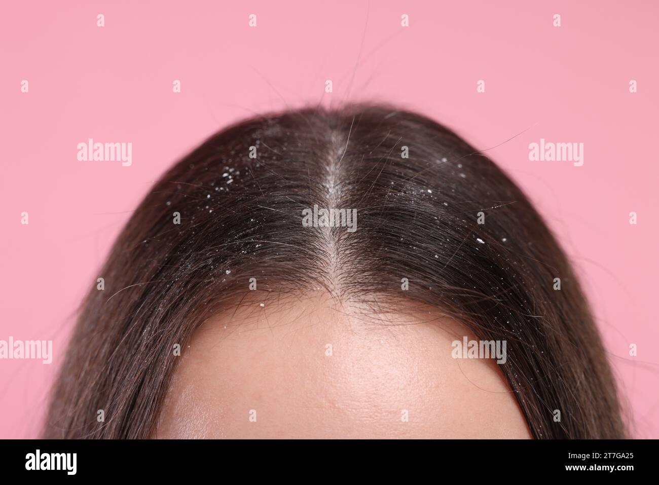 Woman with dandruff problem on pink background, closeup Stock Photo - Alamy
