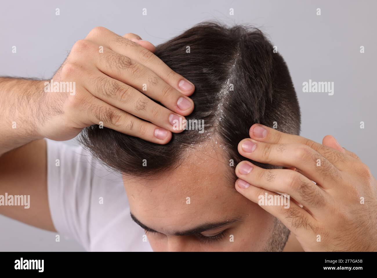 Man with dandruff in his dark hair on light grey background, closeup ...