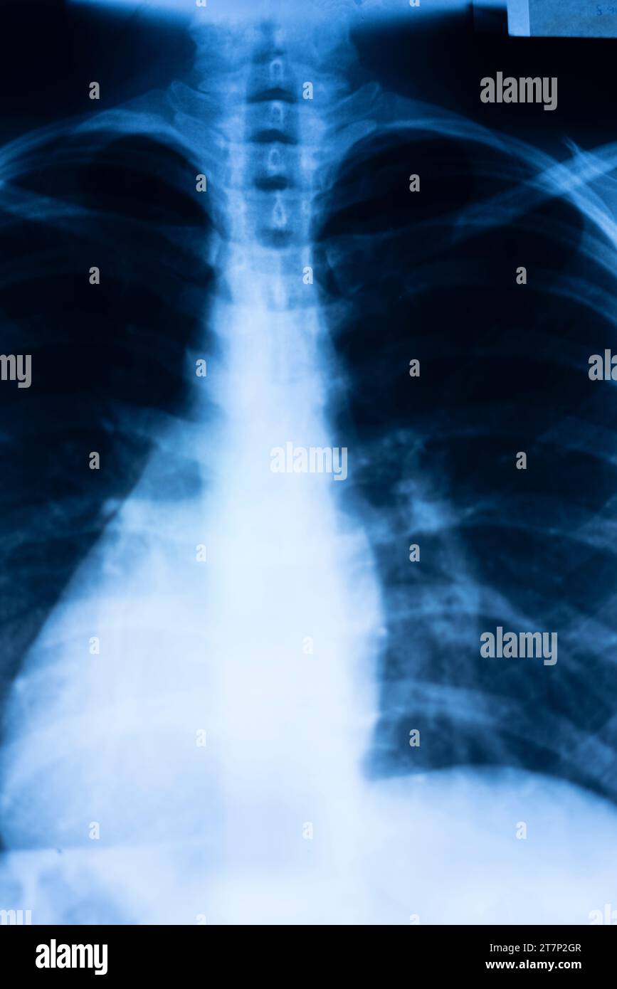 Lungs ribs x-ray scan test result Stock Photo - Alamy