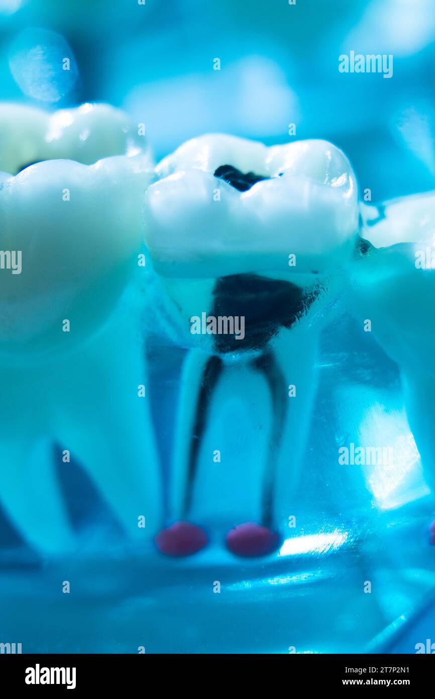 tooth decay going to root canal in teeth teaching medical model Stock ...