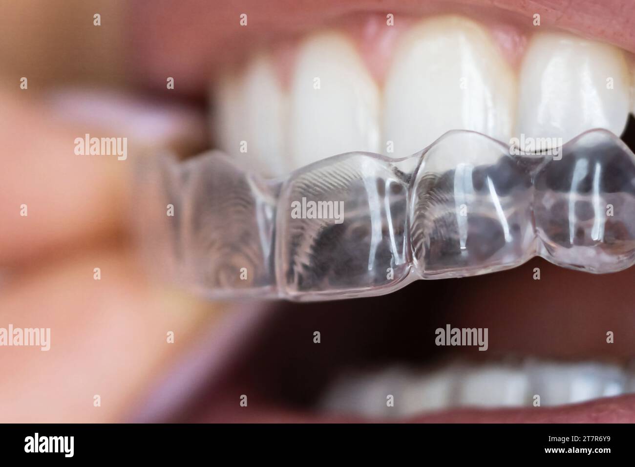 Clear Dental Aligners - Night Guard for Perfect Alignment Stock Photo ...