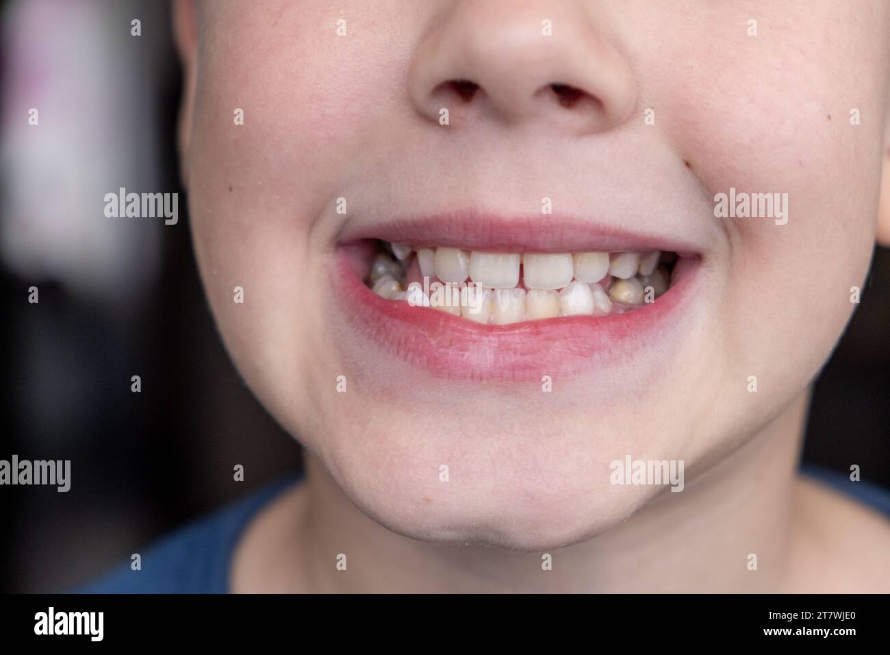Child's crooked teeth. Young man showing crooked growing teeth Stock ...