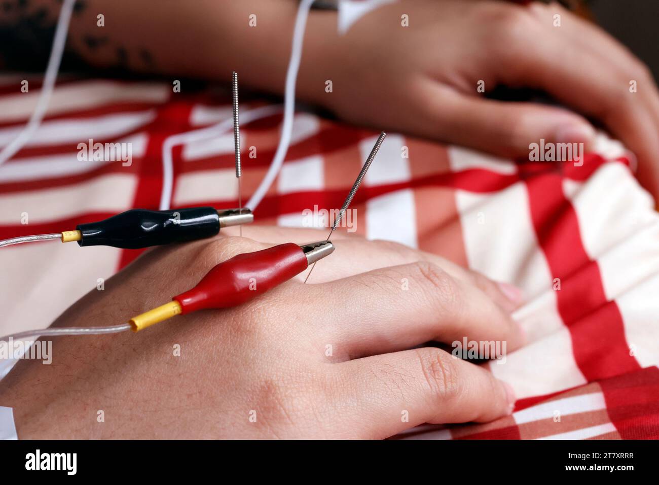 Acupuncture treatment, Vietnamese traditional medicine clinic, Cu Chi ...