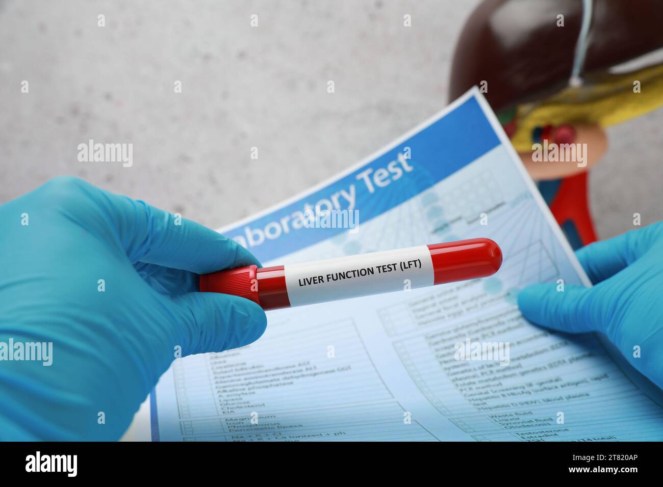 Liver Function Test. Laboratory worker holding tube with blood sample ...
