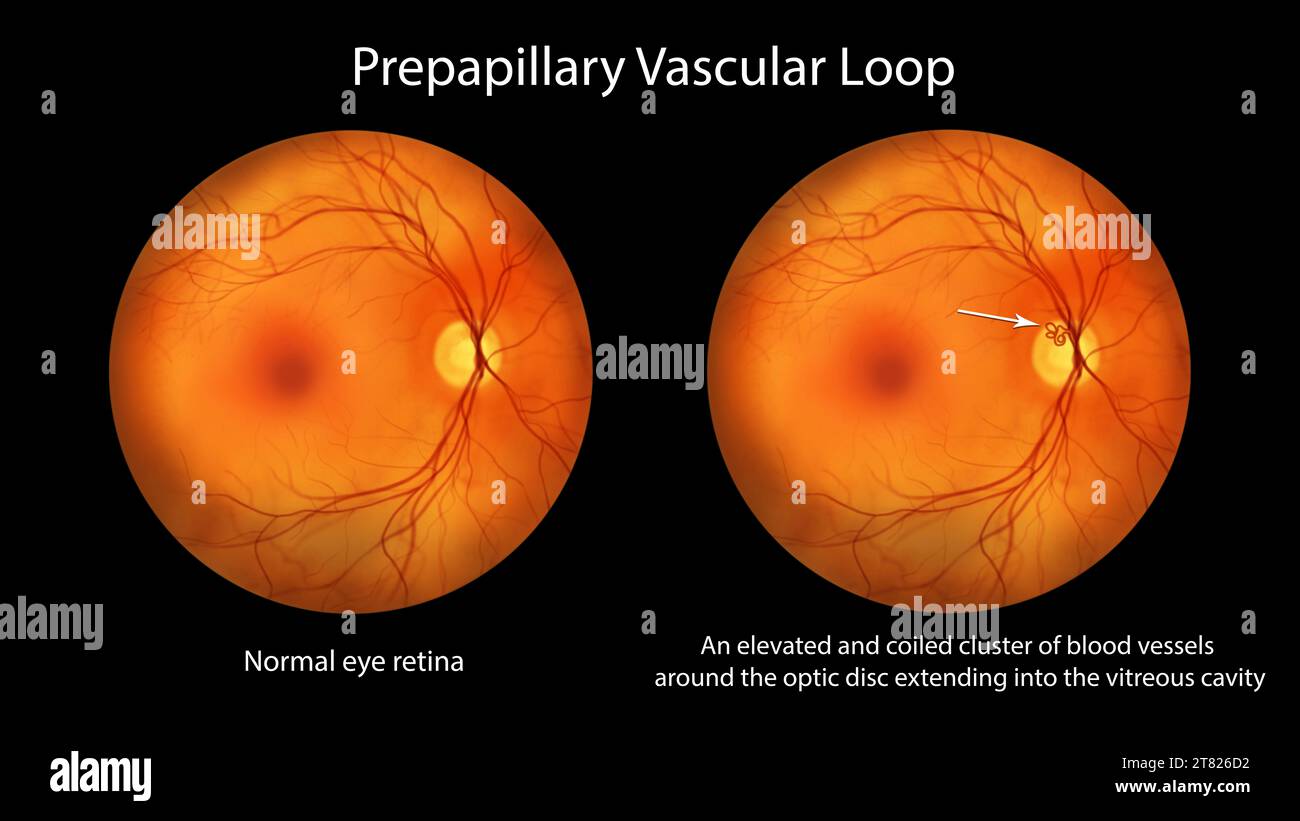 Prepapillary vascular loop on the retina, illustration Stock Photo - Alamy