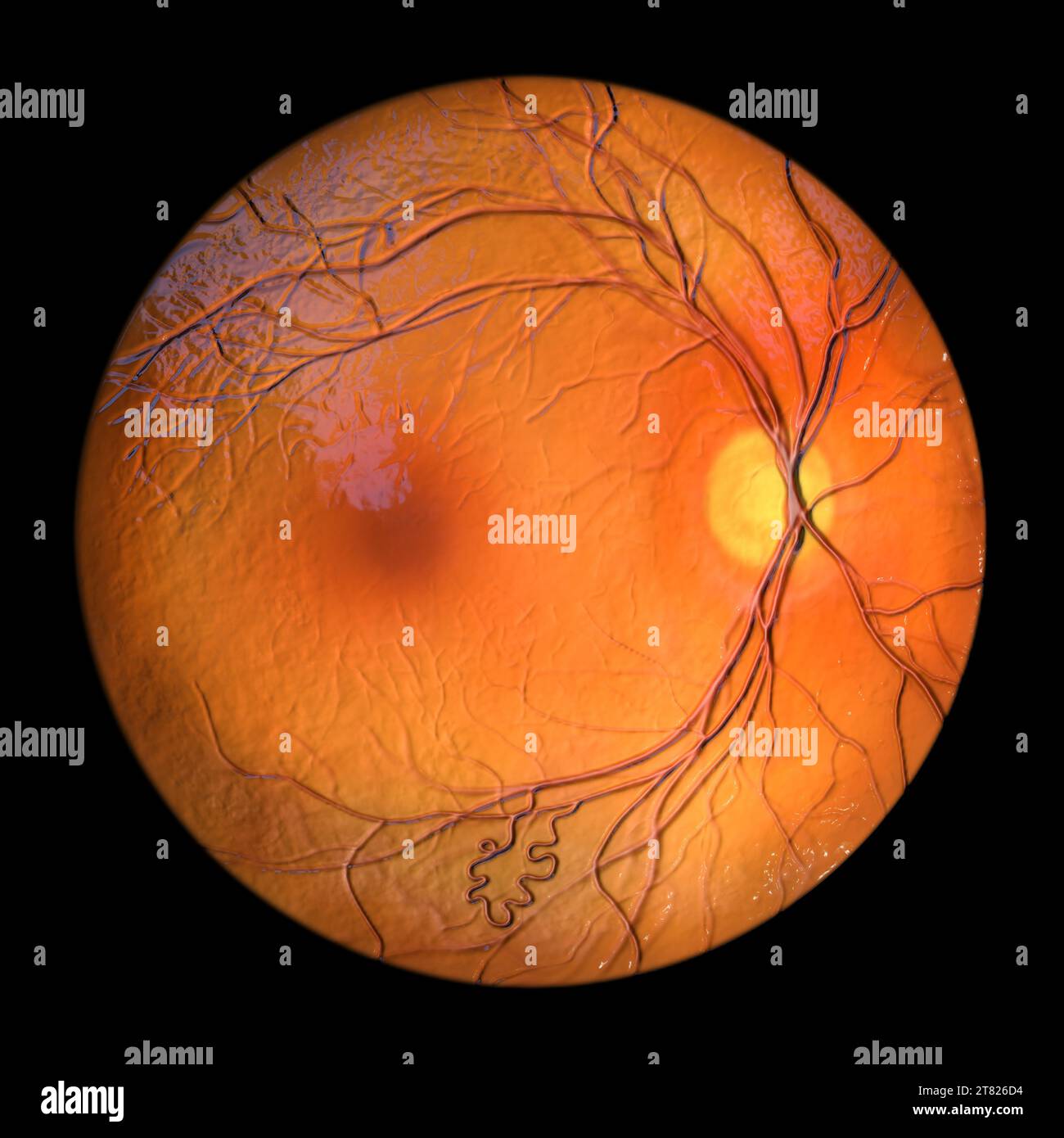 Retinal arteriovenous malformation, illustration Stock Photo - Alamy Retinal arteriovenous malformation, illustration Stock Photo - Alamy