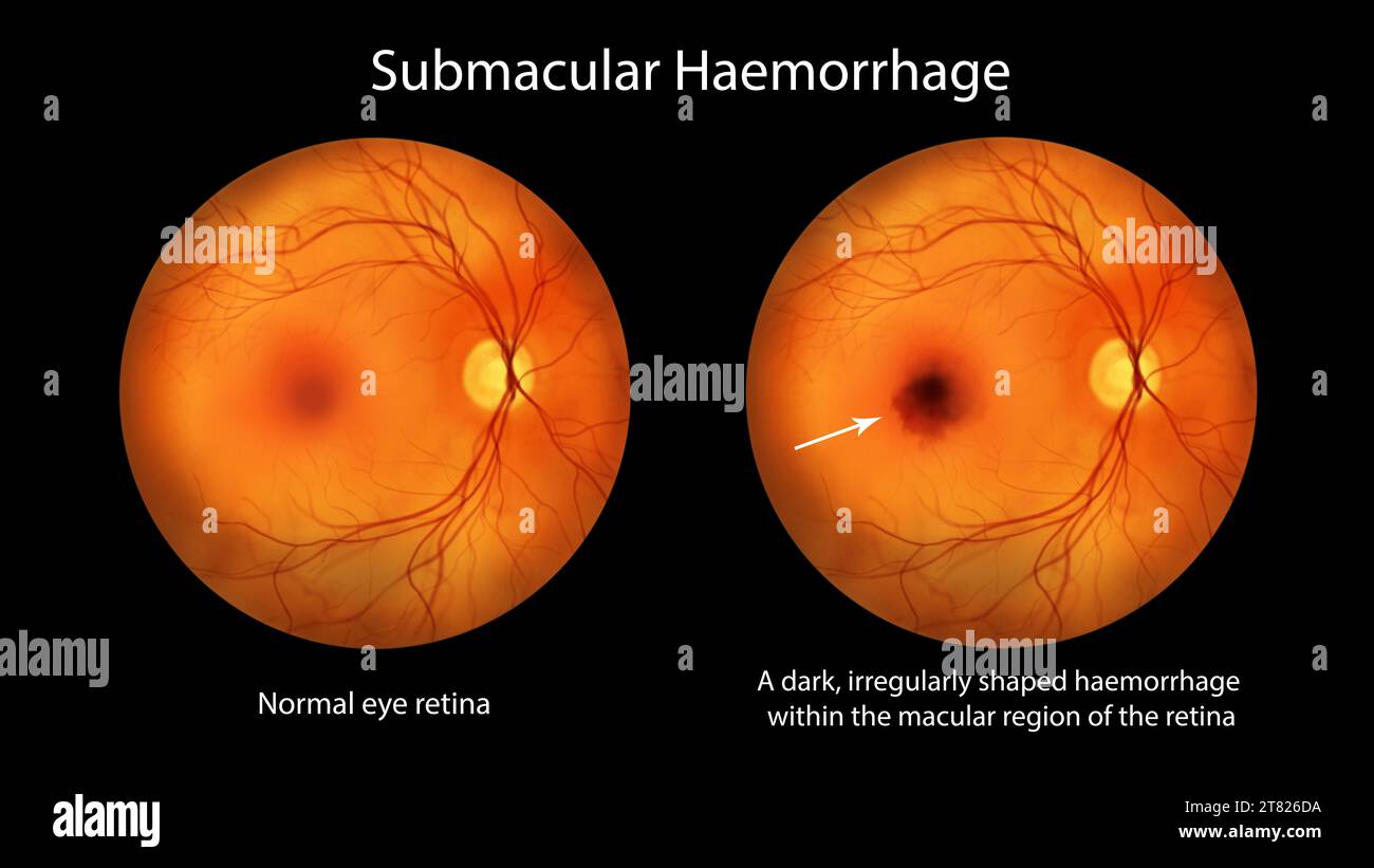 Submacular haemorrhage on the retina, illustration Stock Photo - Alamy