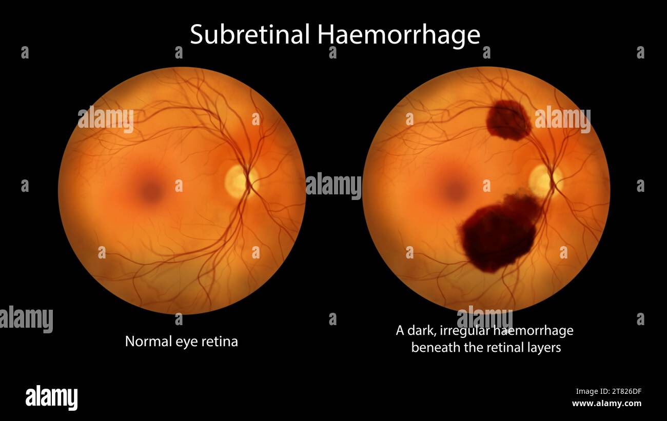 Illustration of a subretinal haemorrhage observed during ophthalmoscopy ...