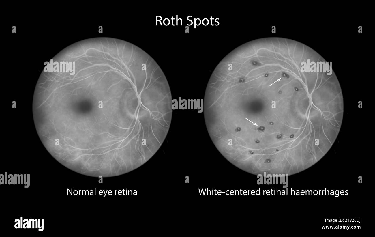 Roth spots in the retina, illustration Stock Photo - Alamy
