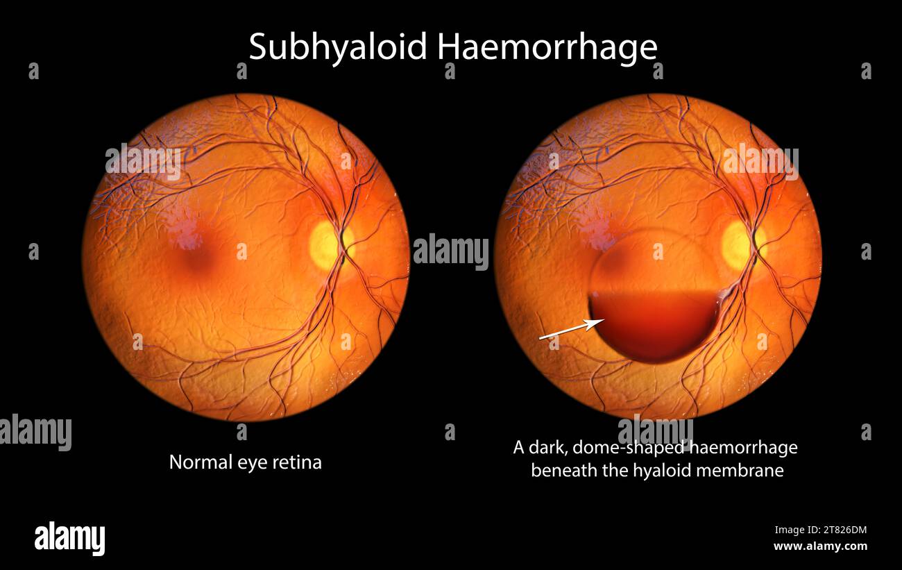 Subhyaloid haemorrhage on the retina, illustration Stock Photo - Alamy