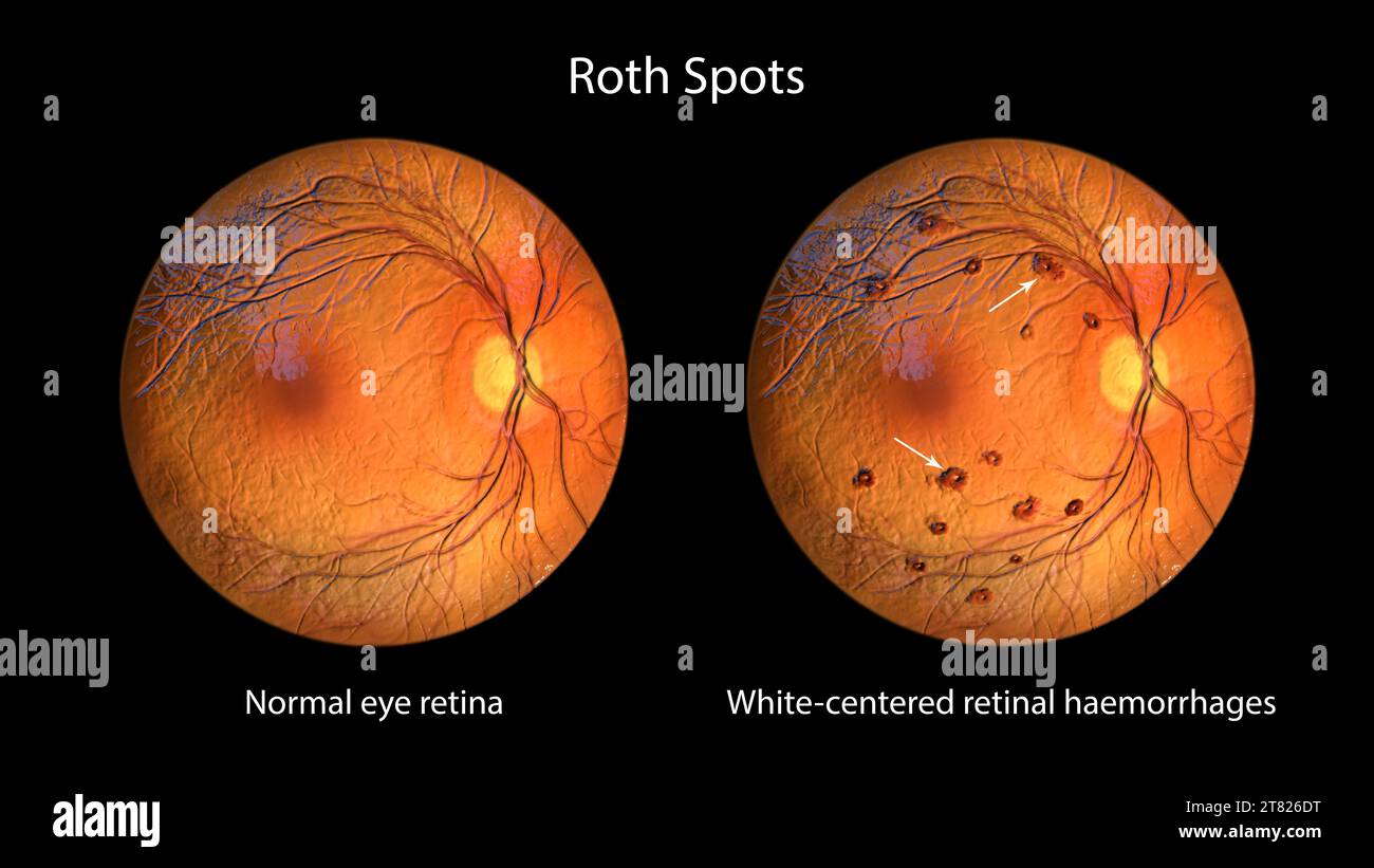 Roth spots in the retina, illustration Stock Photo - Alamy