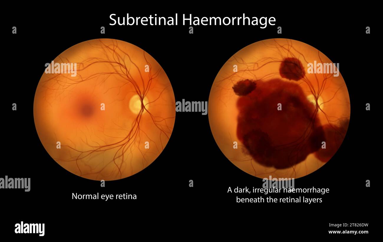 Subretinal haemorrhage on the retina, illustration Stock Photo - Alamy