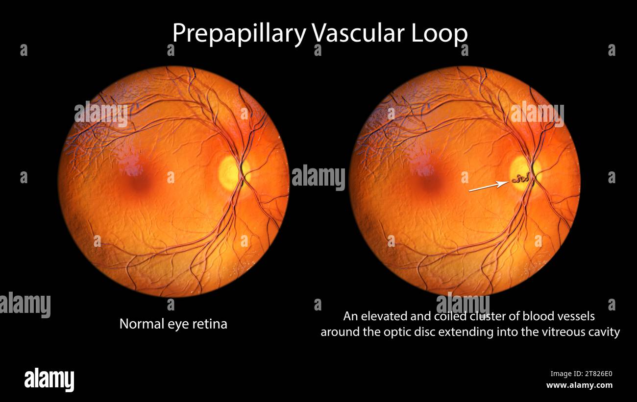Prepapillary vascular loop on the retina, illustration Stock Photo - Alamy